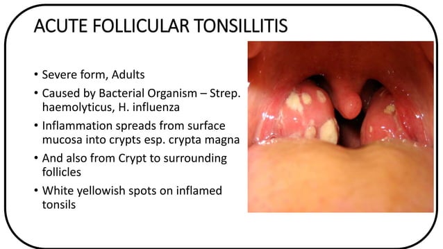 Acute and Chronic Tonsillitis | PPTX | Ear, Nose and Throat Conditions | Diseases and Conditions
