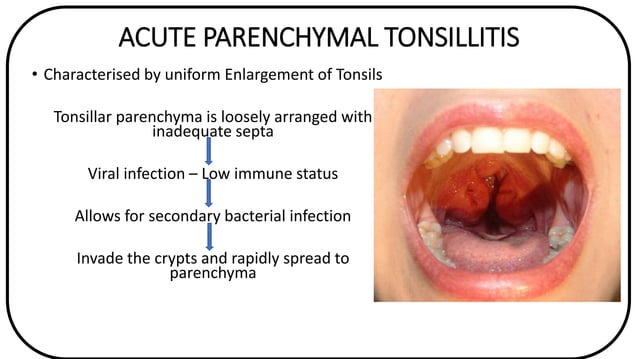 Acute and Chronic Tonsillitis | PPTX | Ear, Nose and Throat Conditions | Diseases and Conditions