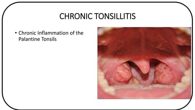 Acute and Chronic Tonsillitis | PPTX | Ear, Nose and Throat Conditions ...