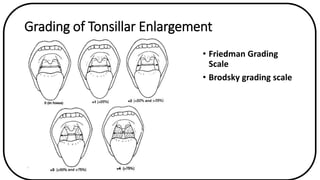 Acute and Chronic Tonsillitis | PPTX