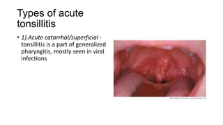 acute & chronic tonsillitis.pptx