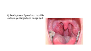 acute & chronic tonsillitis.pptx