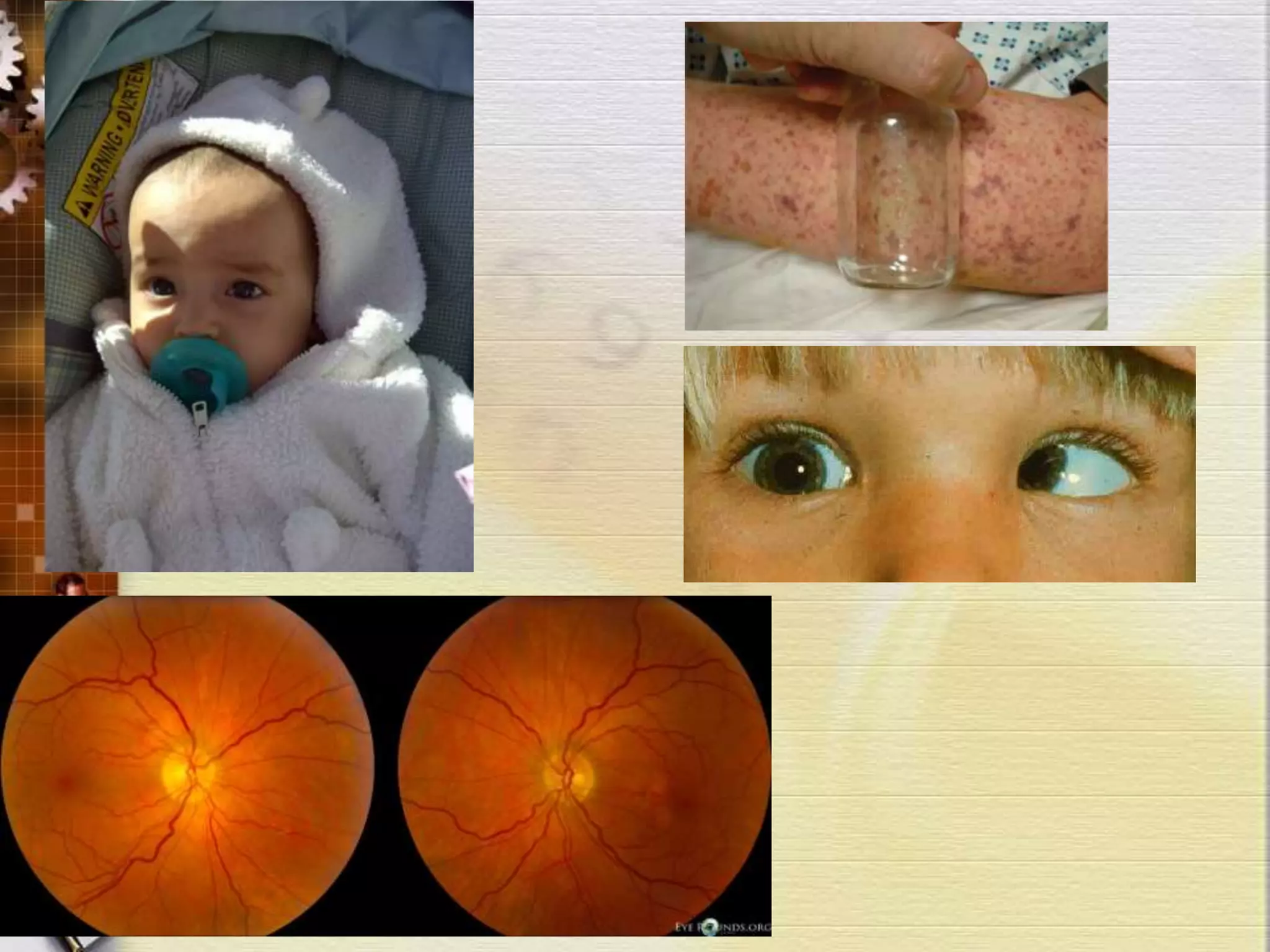 Acute cns infection in children | PPTX