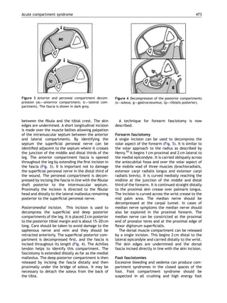 Acute compartment syndrome | PDF