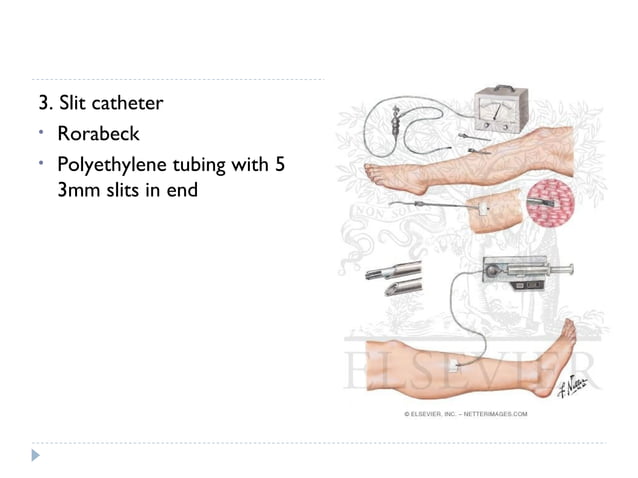 Acute compartment syndrome | PPT