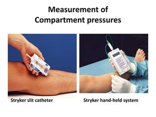 Acute compartment syndrome | PPTX