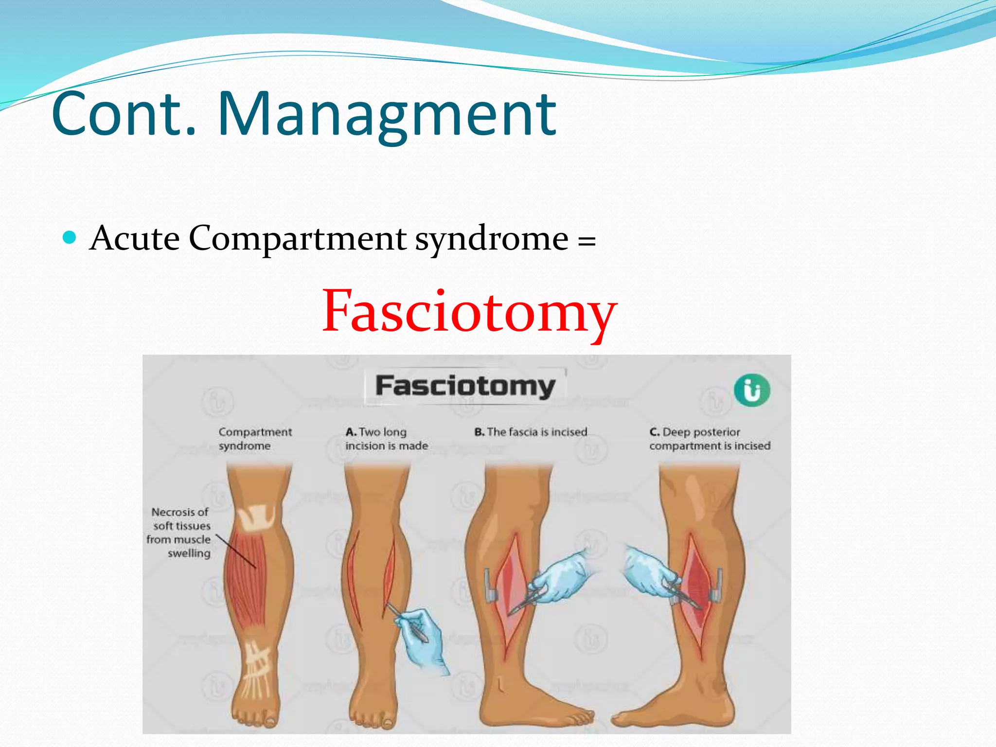 acute Compartment syndrome.pptx | First Aid | Injuries