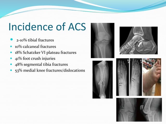 acute Compartment syndrome.pptx | First Aid | Injuries