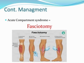acute Compartment syndrome.pptx | First Aid | Injuries