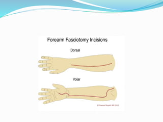 acute Compartment syndrome.pptx | First Aid | Injuries