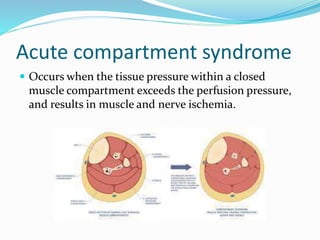 acute Compartment syndrome.pptx | First Aid | Injuries