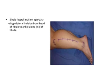 Acute compartment syndrome management.pptx