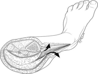 Acute compartment syndrome and volkmann's ischemic contracture | PPT