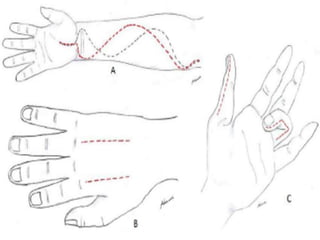Acute compartment syndrome and volkmann's ischemic contracture | PPT