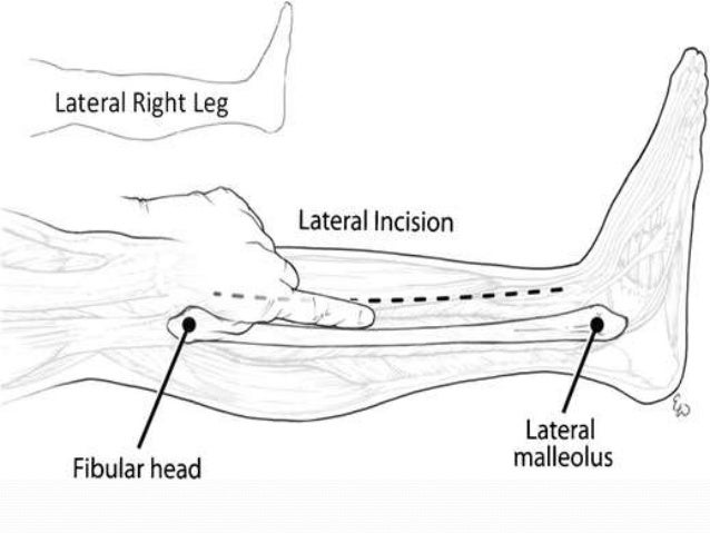 Acute compartment syndrome and volkmann's ischemic contracture