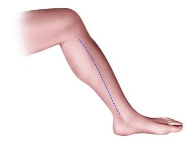 Acute compartment syndrome and volkmann's ischemic contracture