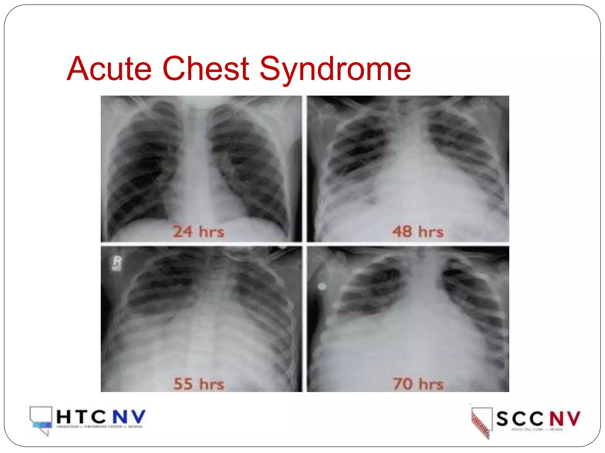 Acute Complications of SCD.pptx