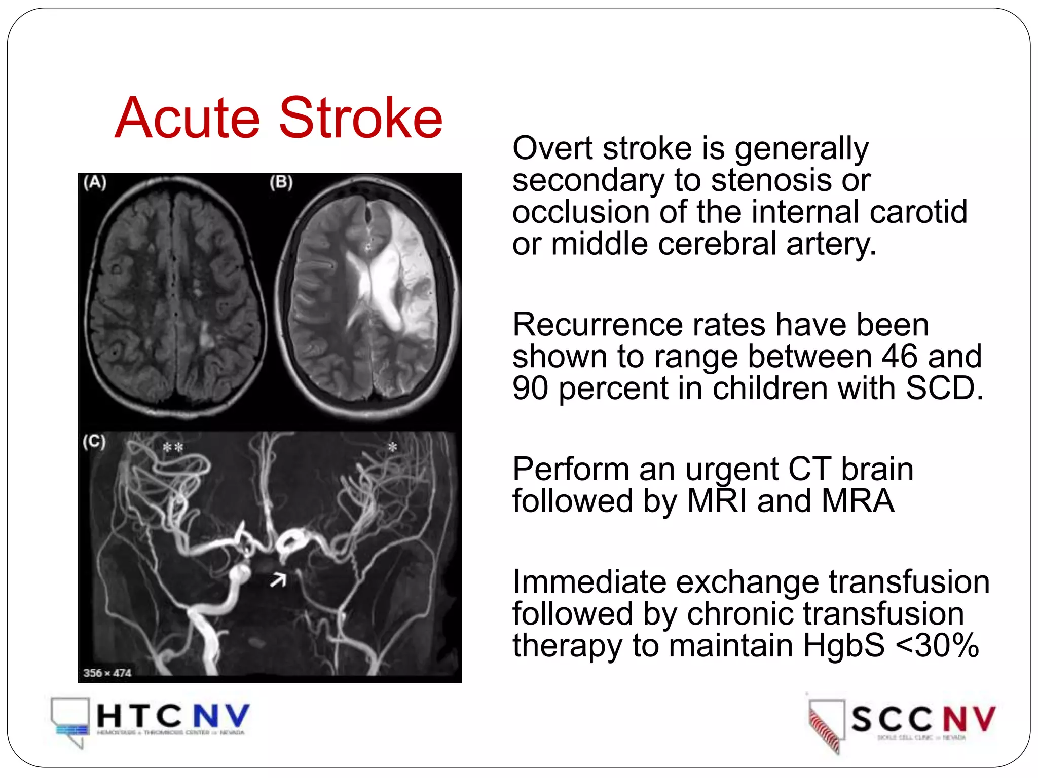 Acute Complications of SCD.pptx