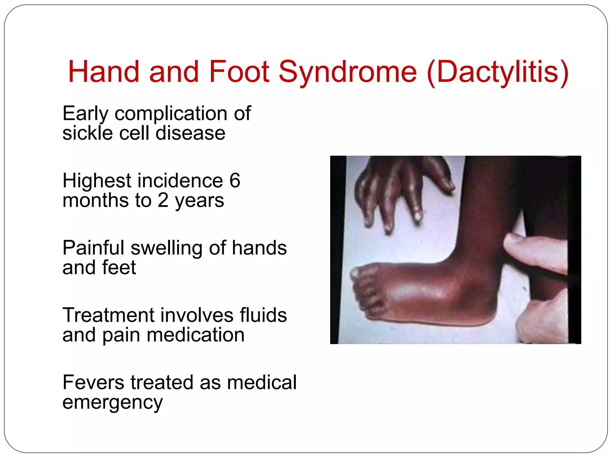 Acute Complications of SCD.pptx