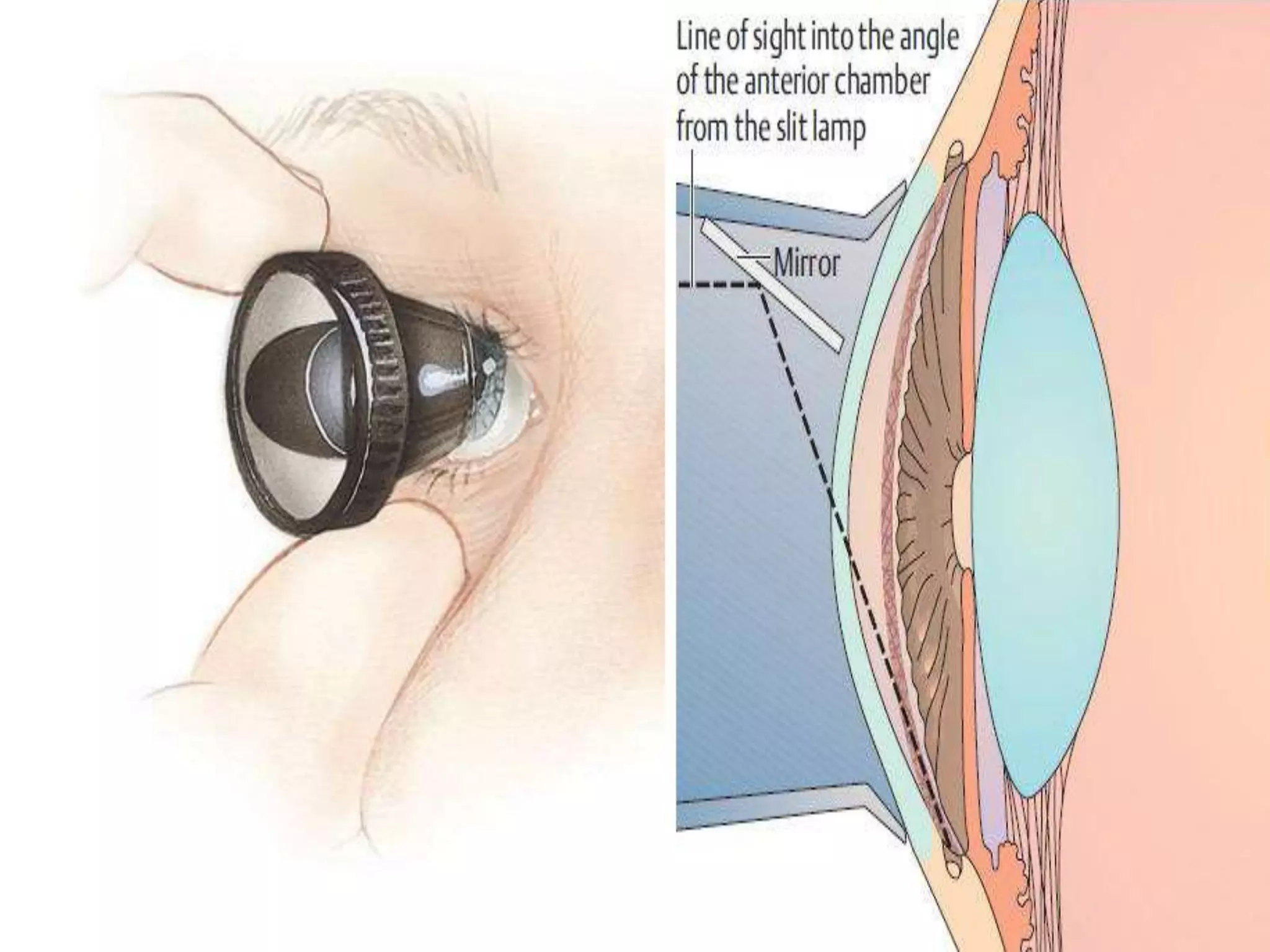 primary closed angle glaucoma (Acute congestive glaucoma) | PPTX