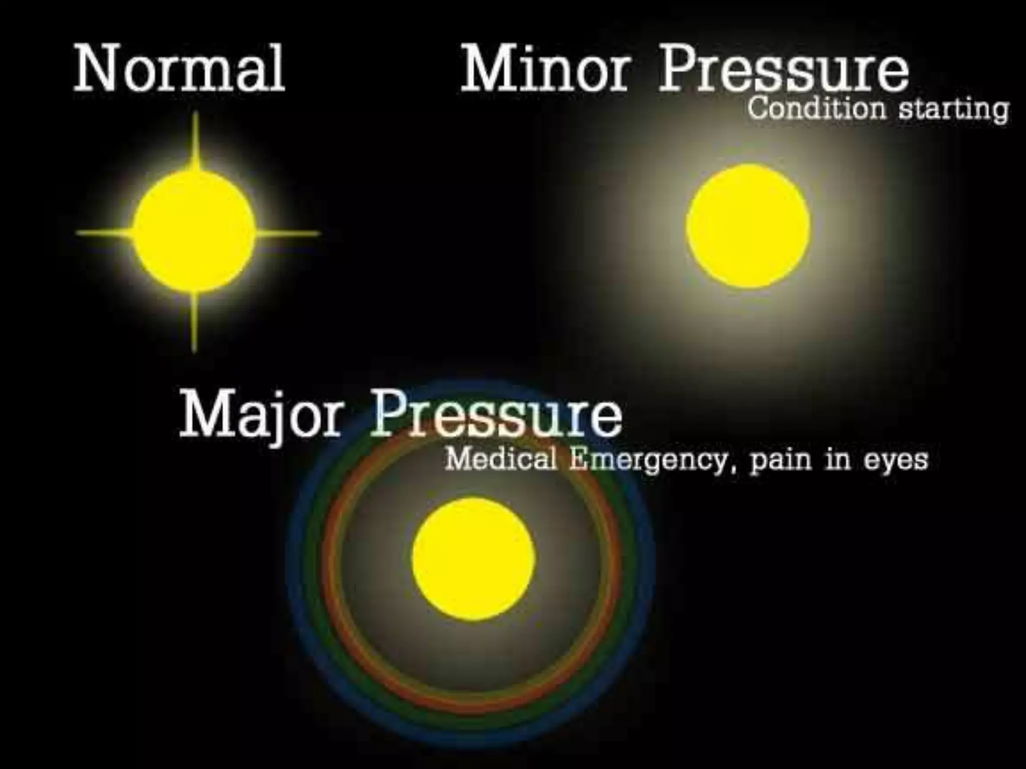 primary closed angle glaucoma (Acute congestive glaucoma) | PPTX