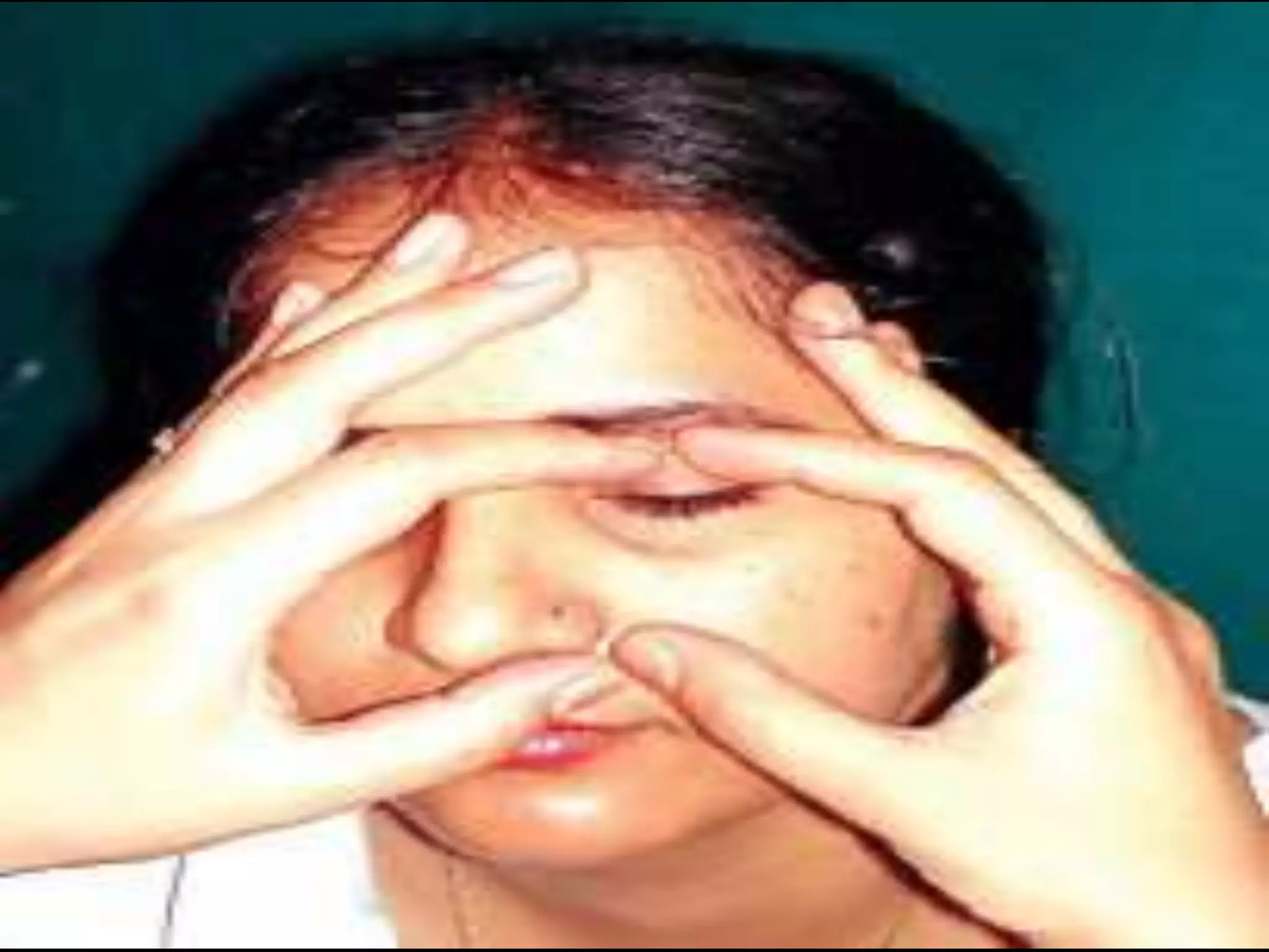 primary closed angle glaucoma (Acute congestive glaucoma) | PPTX