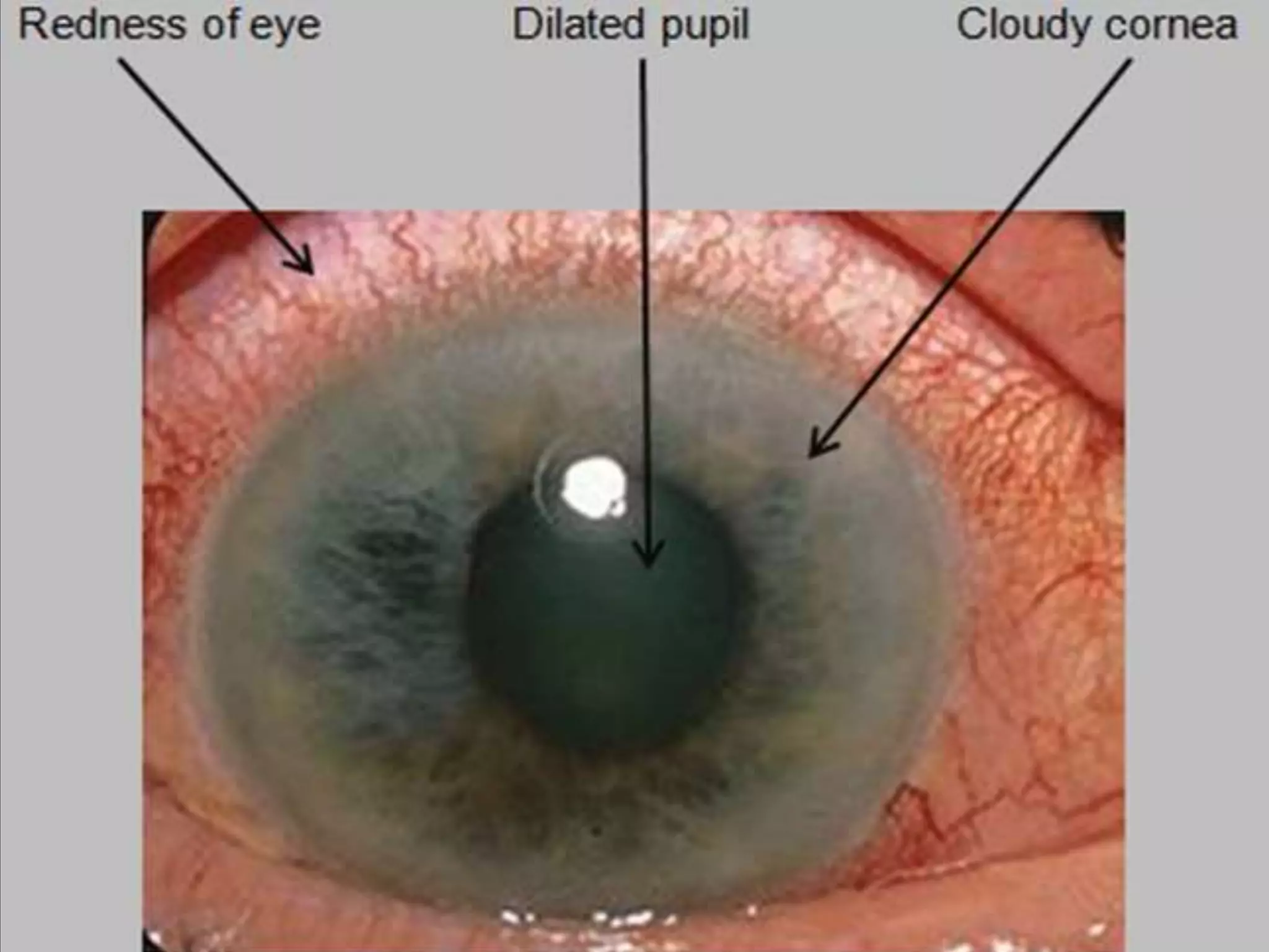 primary closed angle glaucoma (Acute congestive glaucoma) | PPTX