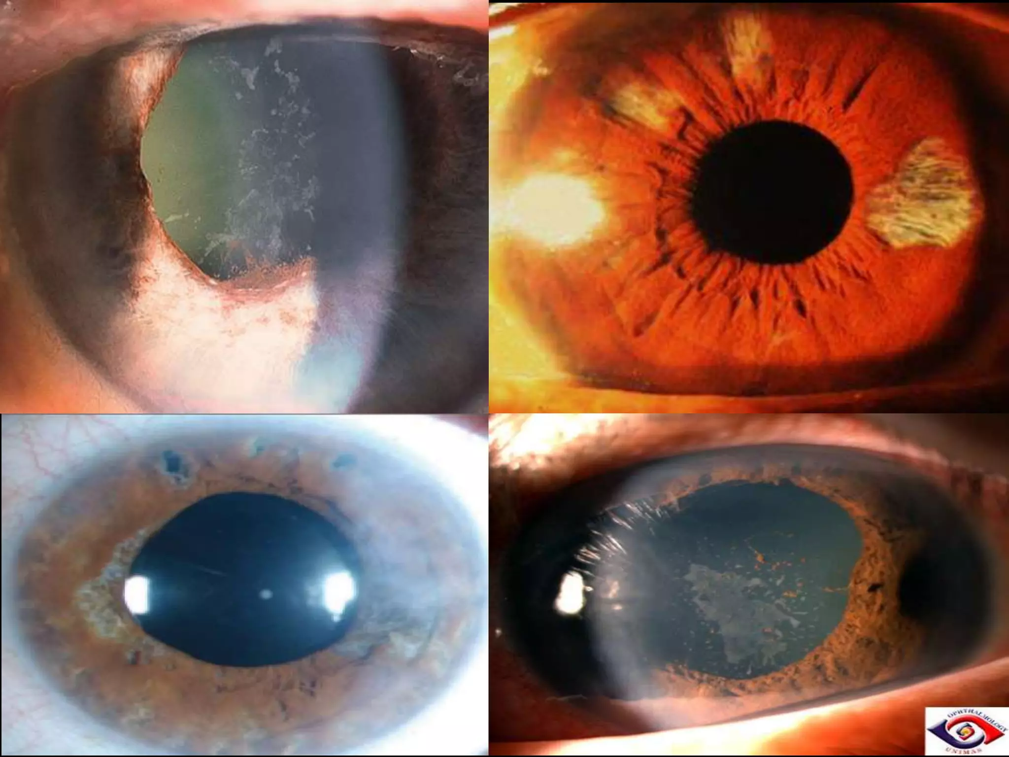 primary closed angle glaucoma (Acute congestive glaucoma) | PPTX