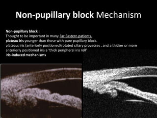 primary closed angle glaucoma (Acute congestive glaucoma) | PPTX