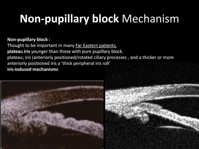 primary closed angle glaucoma (Acute congestive glaucoma) | PPTX