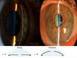 primary closed angle glaucoma (Acute congestive glaucoma) | PPTX