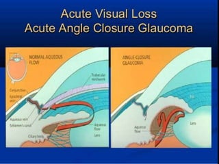 primary closed angle glaucoma (Acute congestive glaucoma) | PPTX