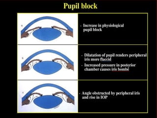 primary closed angle glaucoma (Acute congestive glaucoma) | PPTX