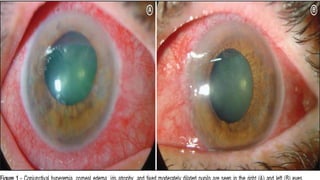 ACUTE CONGESTIVE GLAUCOMA.pptx
