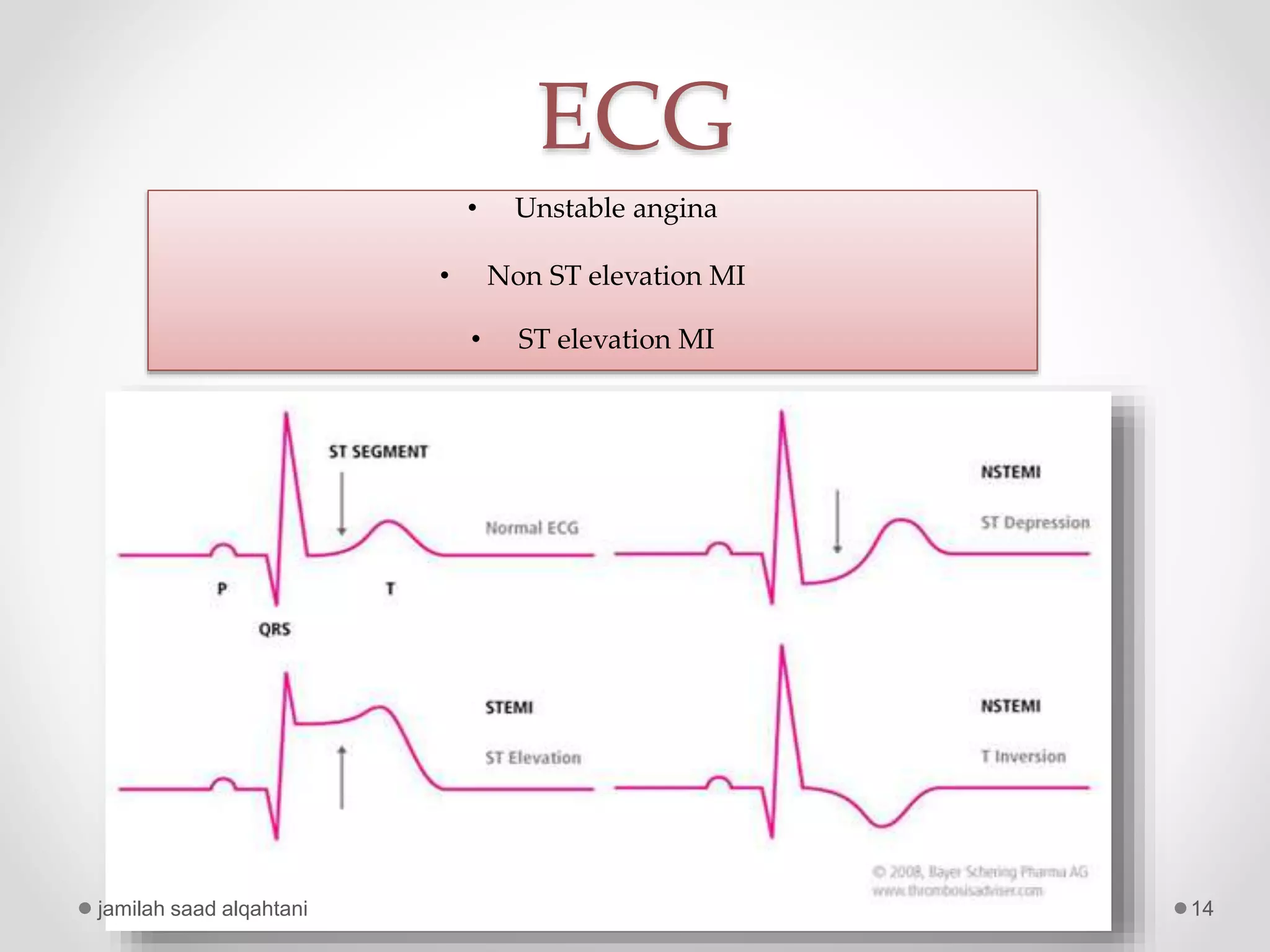 Acute coronary syndrom | PPTX