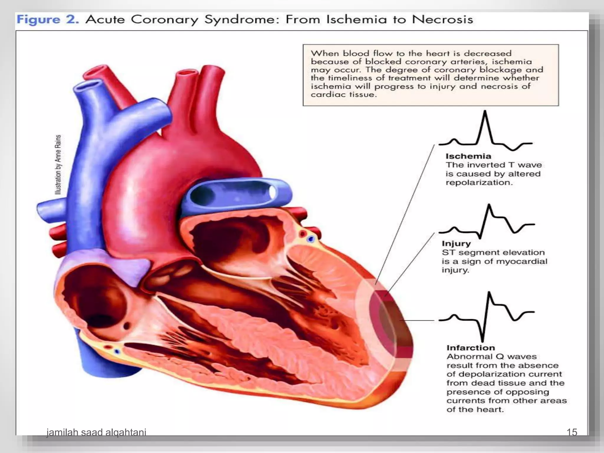 Acute coronary syndrom | PPTX
