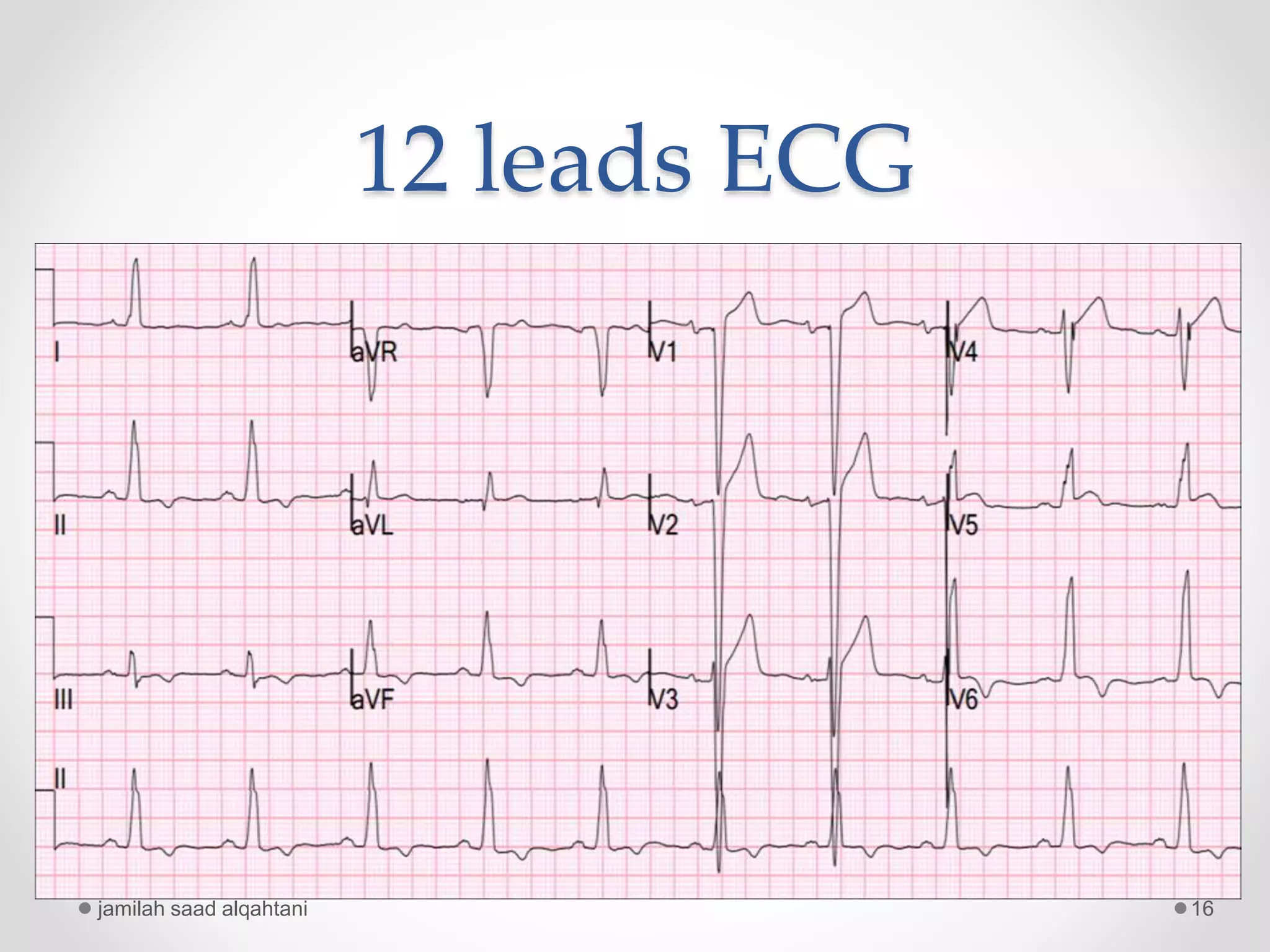 Acute coronary syndrom | PPTX