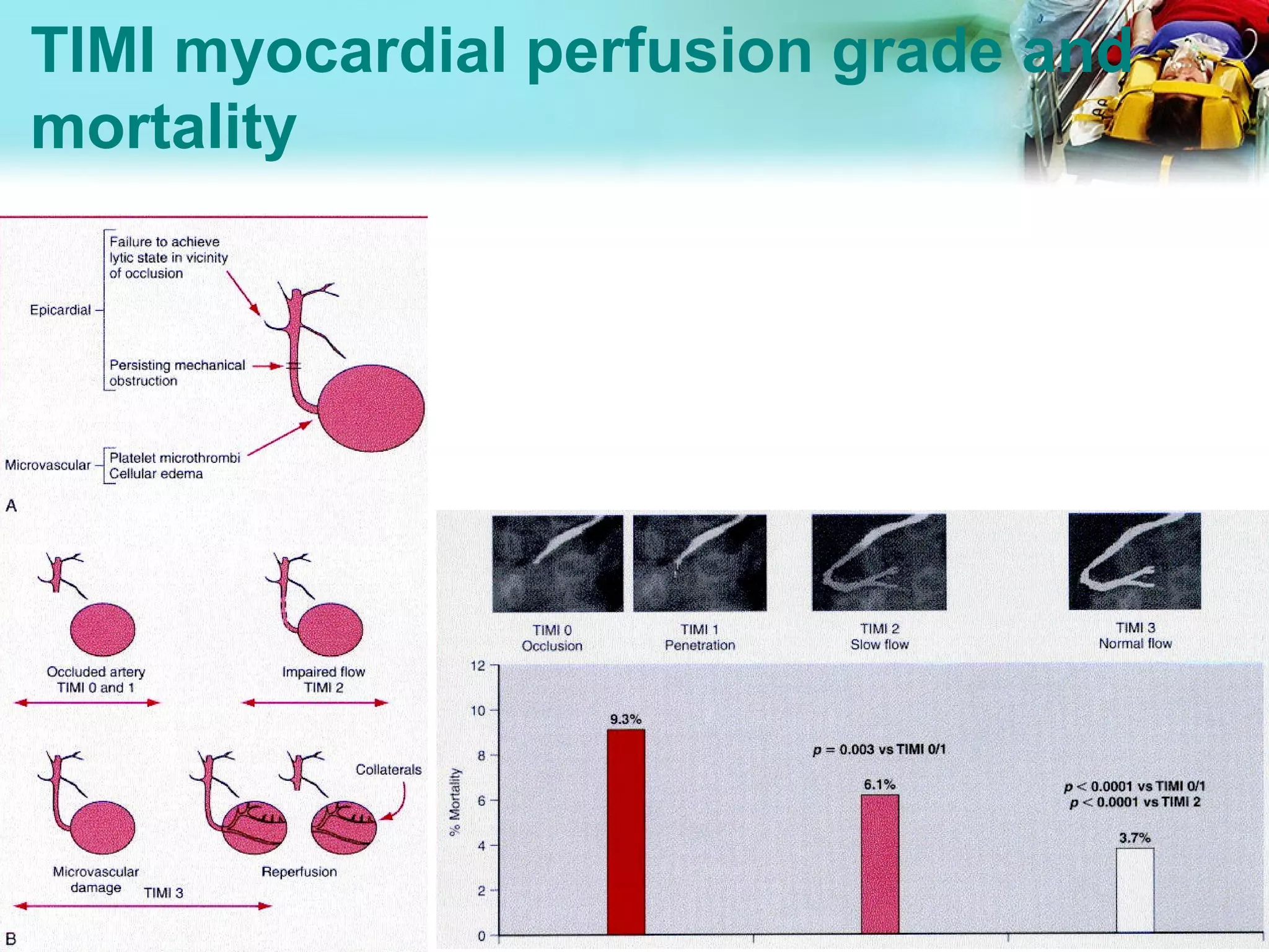 Acute coronary syndrome | PPT
