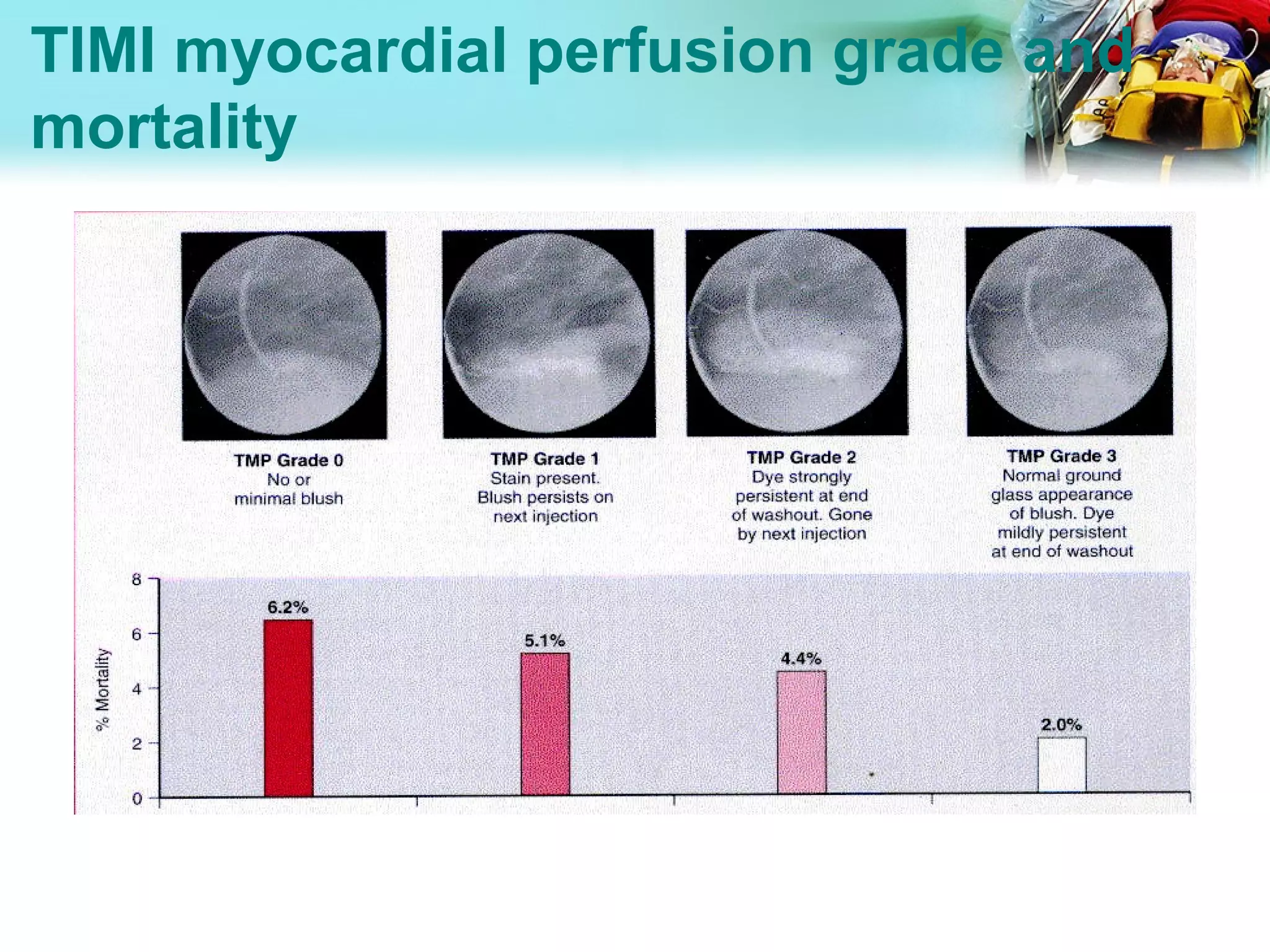 Acute coronary syndrome | PPT