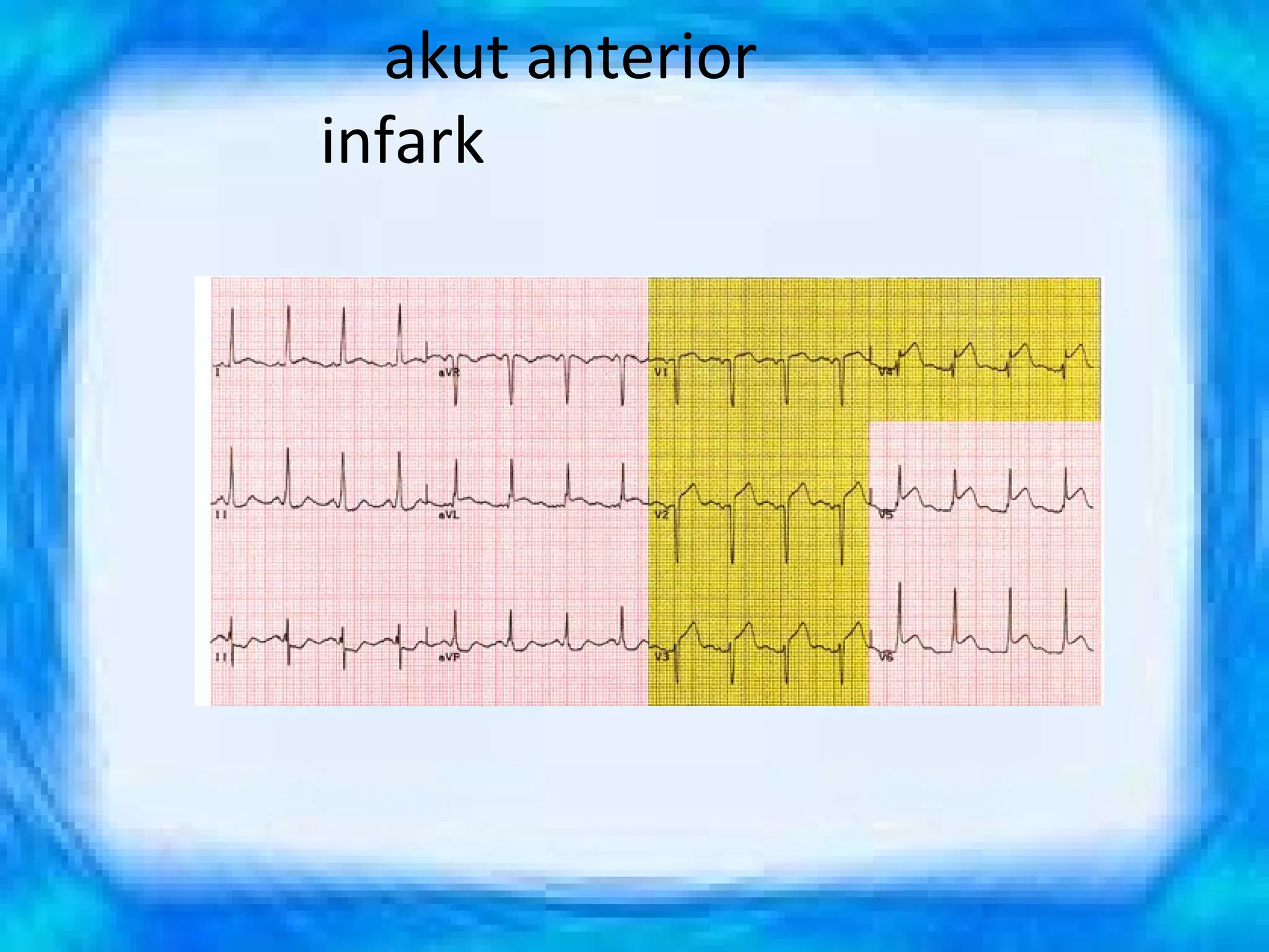 Acute coronary syndrome | PPT
