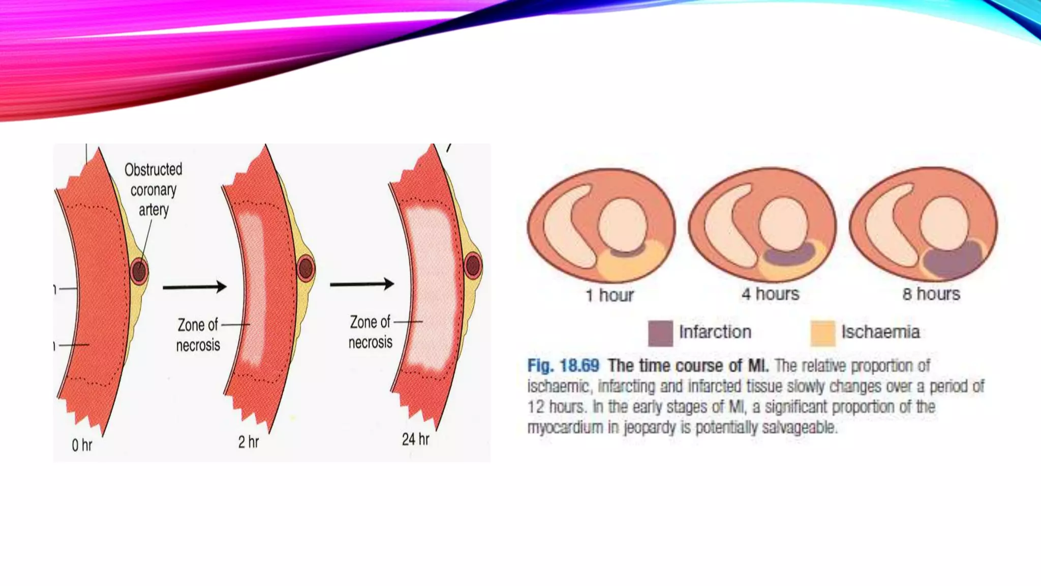 Acute Coronary Syndrome (ACS), Medicine | PPTX