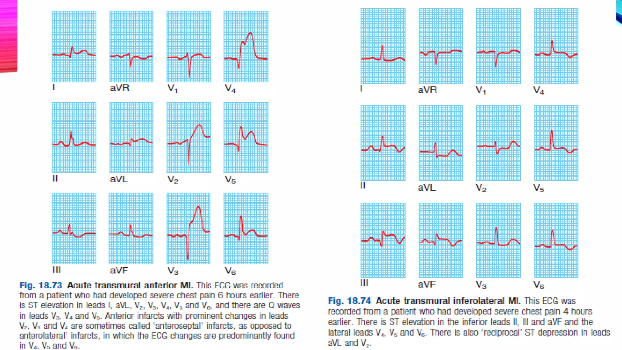 Acute Coronary Syndrome (ACS), Medicine | PPTX