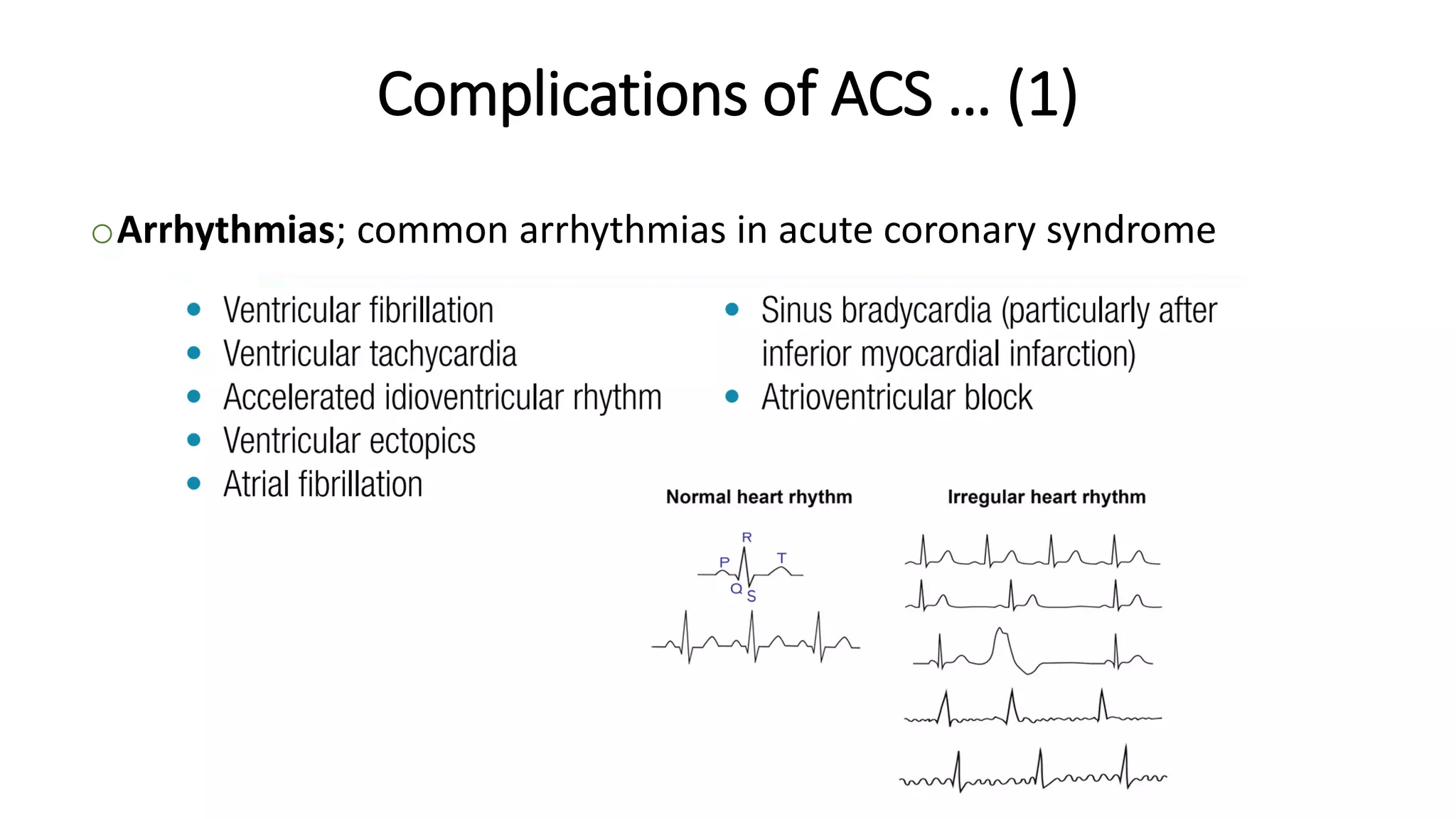 Acute Coronary Syndrome | PDF