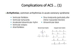 Acute Coronary Syndrome | PDF