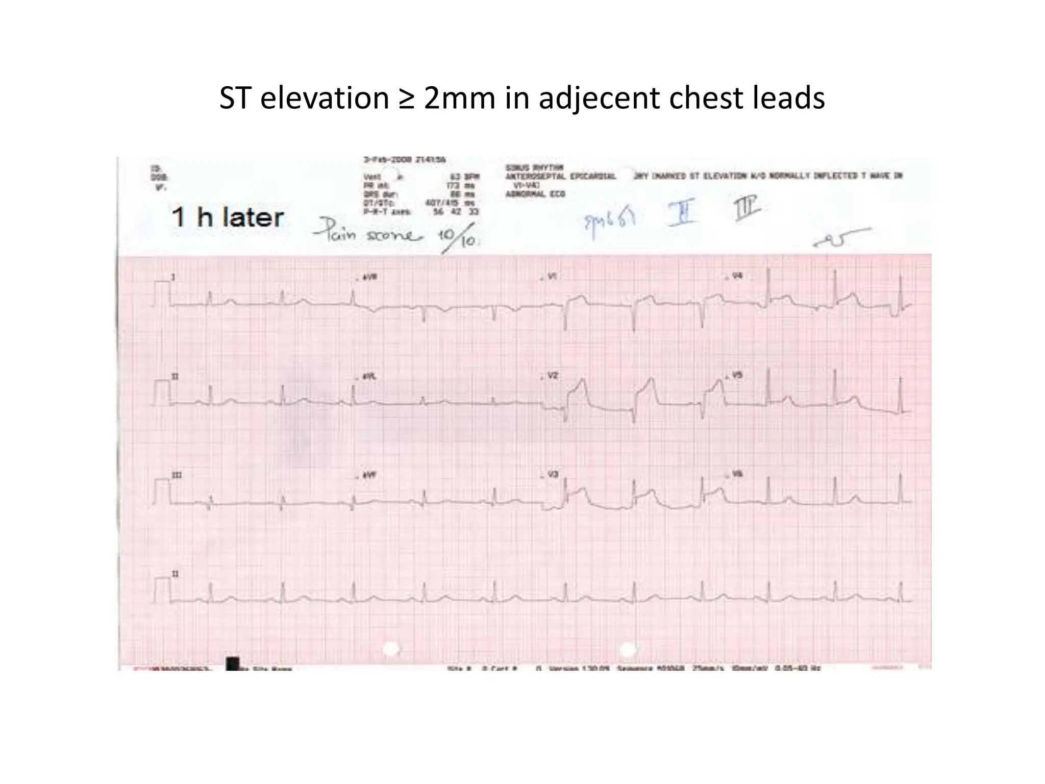 ACUTE CORONARY SYNDROME ACS Heart Health.pptx