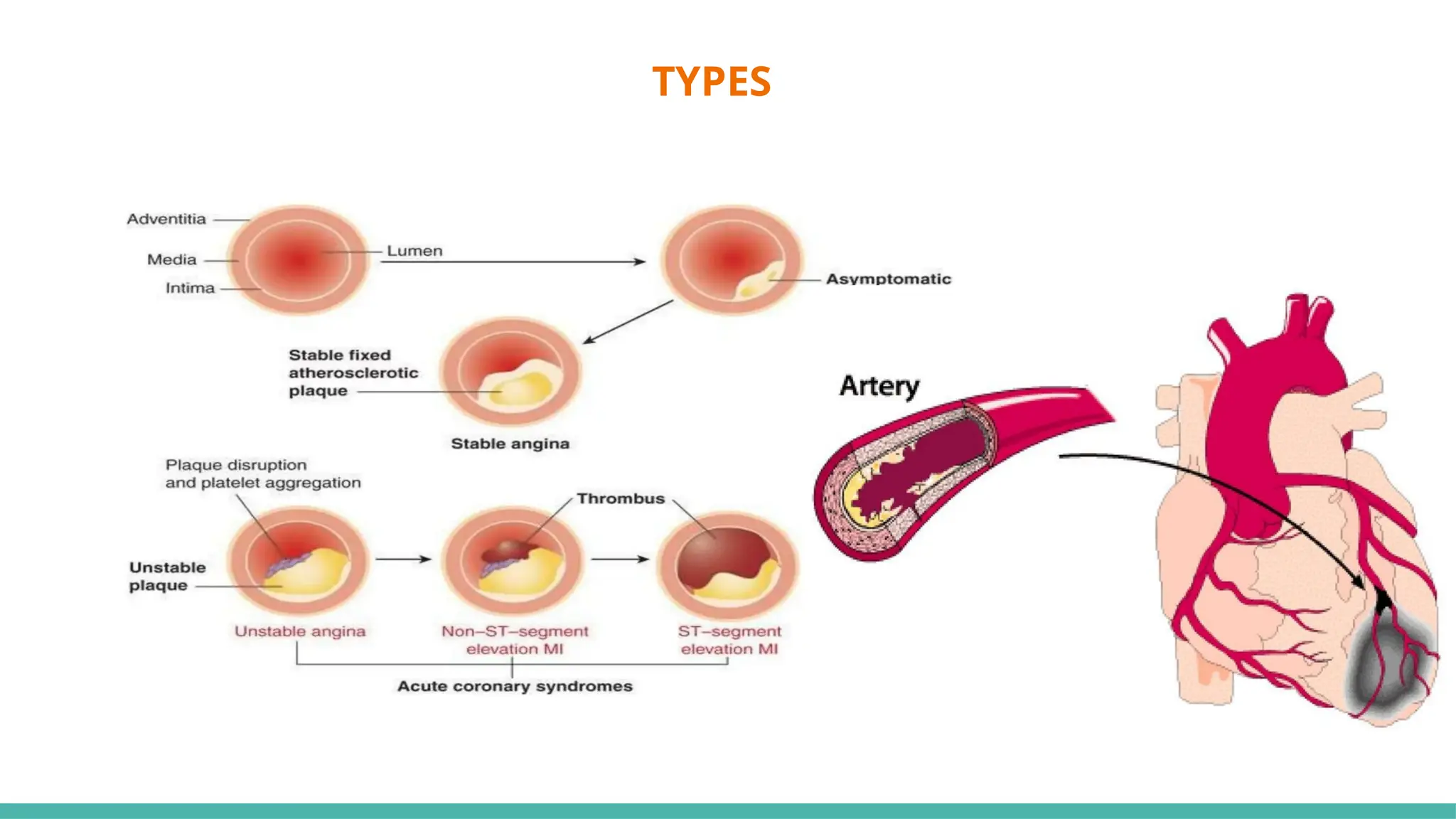 ACUTE CORONARY SYNDROME BY DR.NITHA , 2022 | PPTX