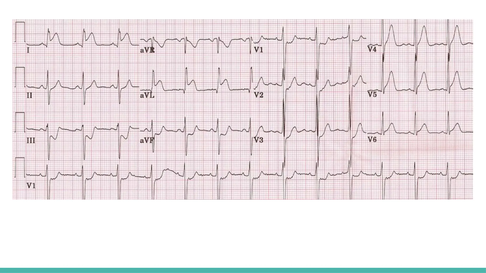 ACUTE CORONARY SYNDROME BY DR.NITHA , 2022 | PPTX