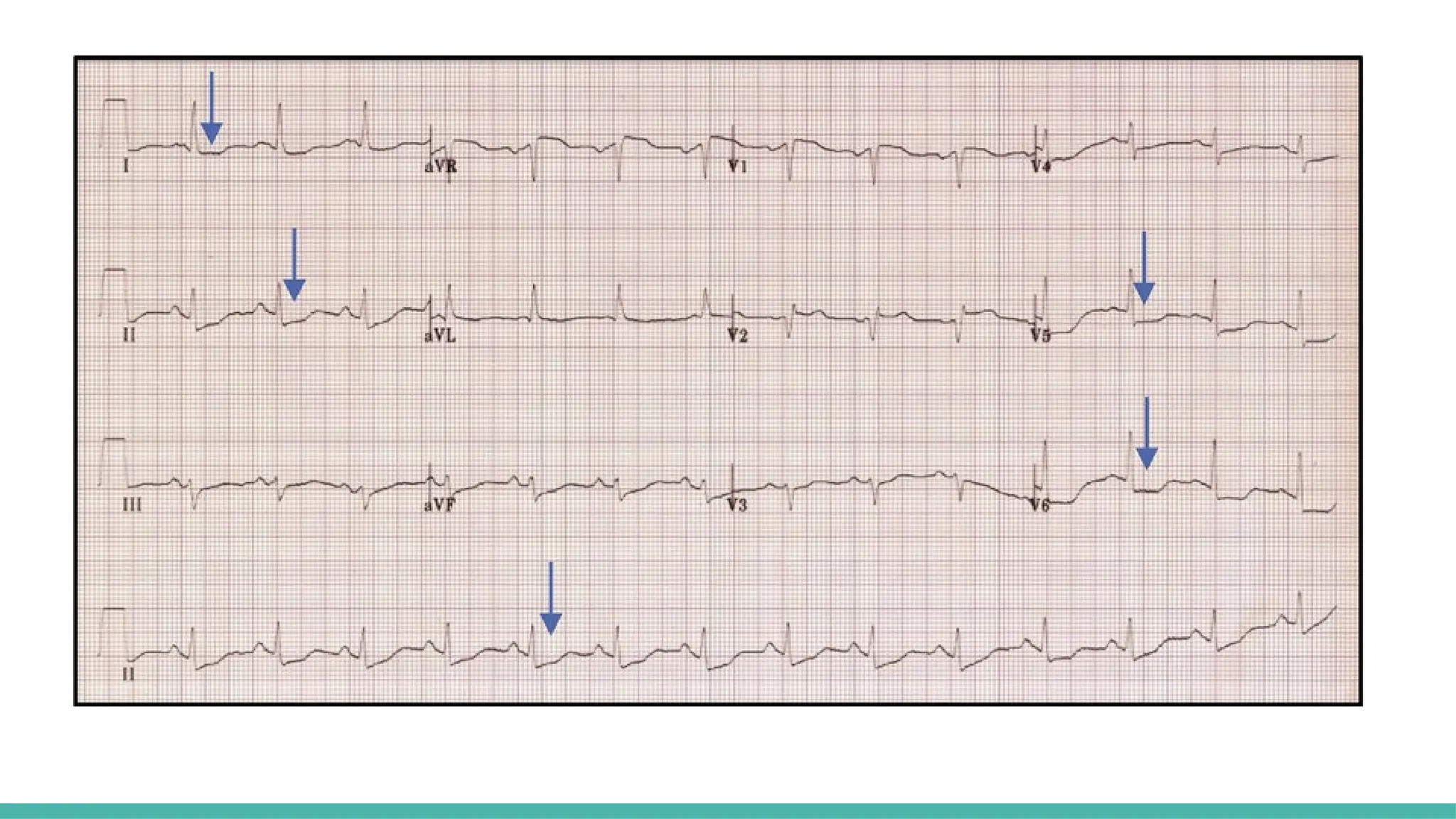 ACUTE CORONARY SYNDROME BY DR.NITHA , 2022 | PPTX