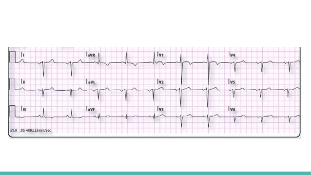 ACUTE CORONARY SYNDROME BY DR.NITHA , 2022 | PPTX