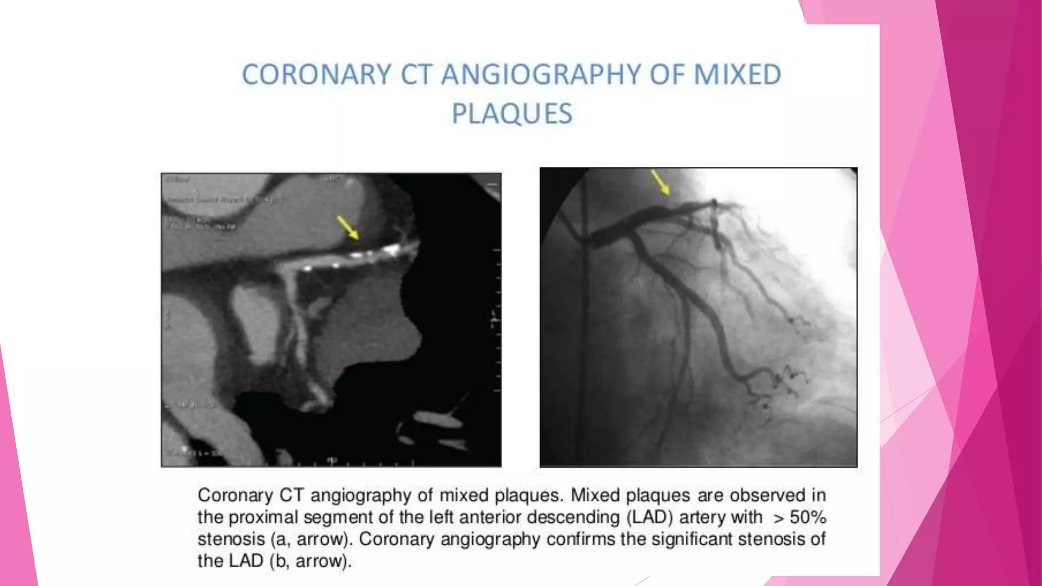 Acute coronary syndrome (acs) | PPTX | Heart and Cardiovascular ...